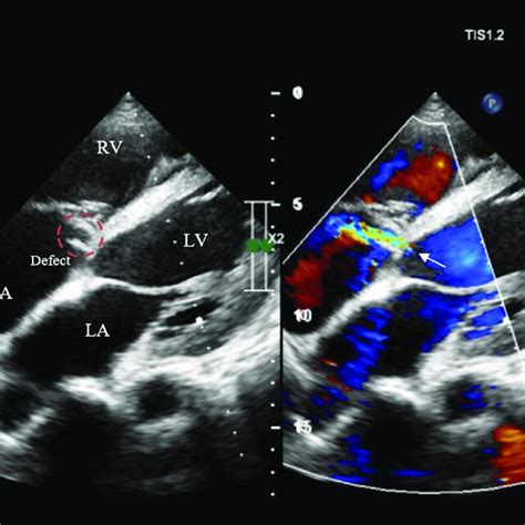 Three Types Of Gerbode Defect Normal Interventricular Septum A Download Scientific Diagram