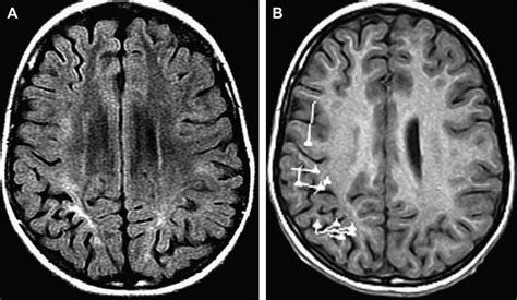 Development And Dysgenesis Of The Cerebral Cortex Malformations Of Cortical Development
