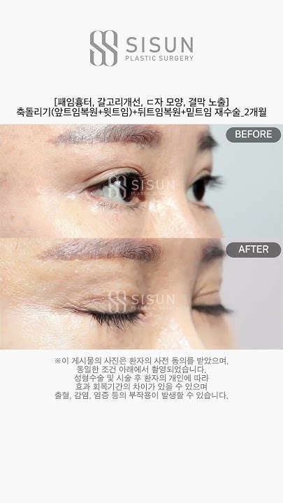 ★패임흉터 갈고리개선 ㄷ자 모양 결막 노출★ 축돌리기앞트임복원윗트임뒤트임복원밑트임 재수술2개월 Youtube