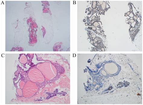 Multifocal Ectopic Thyroid Tissues Including Breast A Case Report Pmc