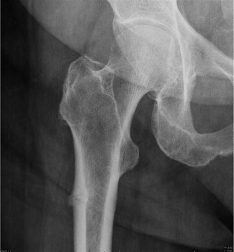 Some Cancer Survivors May Be At Higher Risk For Bone Fracture