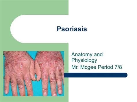 Psoriasis Ppt