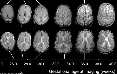 Autism Miswiring And Misfiring In The Cerebral Cortex — Ncsa