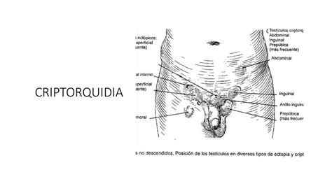 Criptorquidia Mary Mednotes Udocz