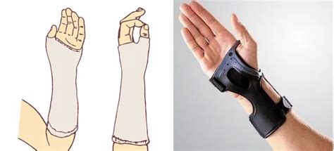 不容易被发现的tfcc损伤 广州华新骨科医院