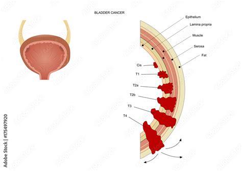 Bladder Cancer Staging