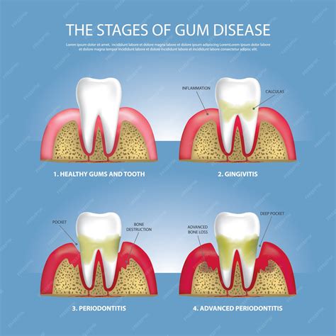 Premium Vector Human Teeth Stages Of Gum Disease Illustration