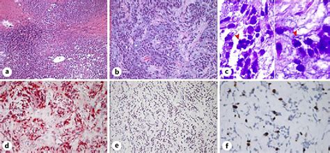 Figure 2 From Diffuse Leptomeningeal Glioneuronal Tumor In Adults Case Report And Literature