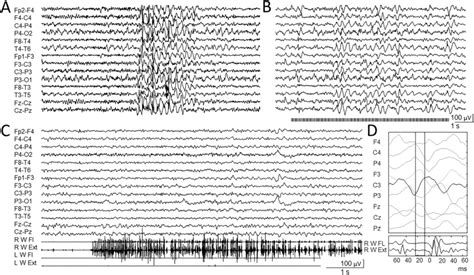 Patient 2 A Brief Absence Seizure B Photoparoxysmal Response To Download Scientific
