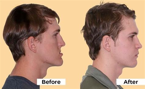 Jaw Surgery Uncovered Types Benefits And Must Know Insights
