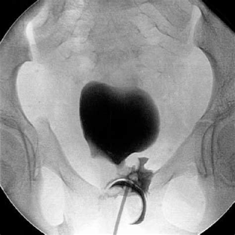 Intraoperative Retrograde Urethrogram Note Fracture Of Right Superior