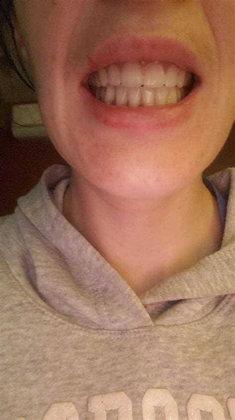 Do These Look Totally Fake Rdentures