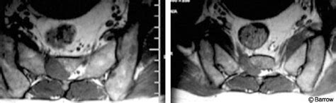 Sacral Amputation For Sarcoma Case Report Barrow Neurological Institute