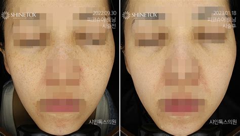 피코토닝 주근깨 잡티 피코토닝 전후사진 대전둔산 샤인톡스의원