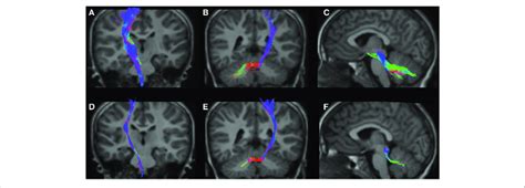 Csd Pt Upper Row And Dti Lower Row Reconstructions Of The Cst Download Scientific Diagram
