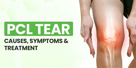 Pcl Tear Causes Symptoms And Effective Treatment Options
