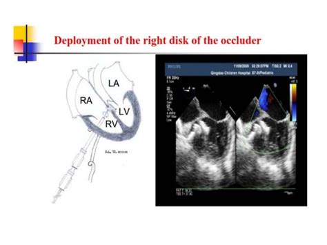 Vsd Closure Hybride Pptx