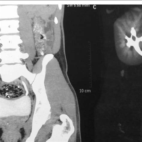 Ct Urography Film Of Patient Showing Crossed Fused Ectopia Download