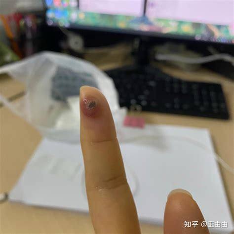 手指上寻常疣液氮冷冻治疗记录 知乎