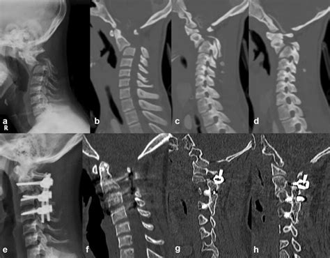 A Pre Operative Lateral Radiograph Showing Displaced And Angulated Download Scientific Diagram A Pre Operative Lateral Radiograph Showing Displaced And Angulated Download Scientific Diagram