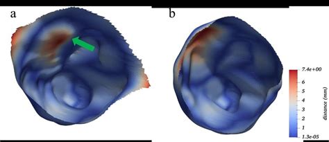 A Patient 3 Post Operative Tumour Cavity Surface With Euclidean