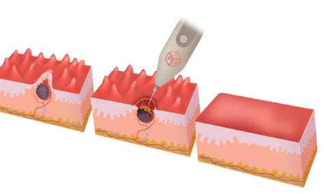What You Need To Know About A Penile Pimple Removal Kit