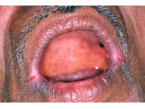 Angular Stomatitis