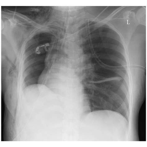 Chest X Ray Showing Tension Pneumothorax Download Sci