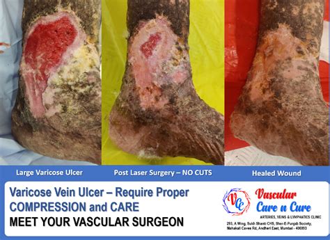 Healed Varicose Veins Ulcer Dr Aniruddha Bhuiyan