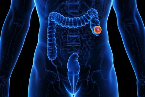 Colon Resection Middle Georgia Surgery Institute