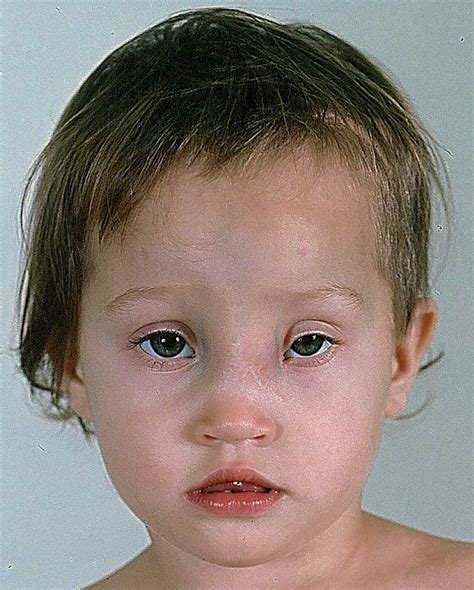 Encephalocele Hellenic Craniofacial Center