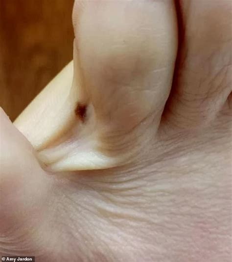 Woman Reveals How Itch Between Toes Turned Out To Be Skin Cancer