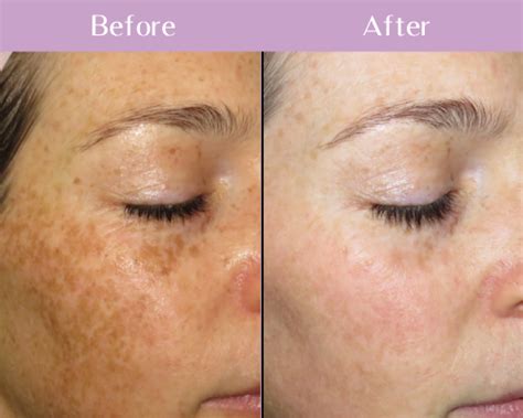 Bbl Laser Treatment Broadband Light Eden Medical