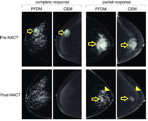 Examples Of Patients With Complete Or Partial Response To Nact Left