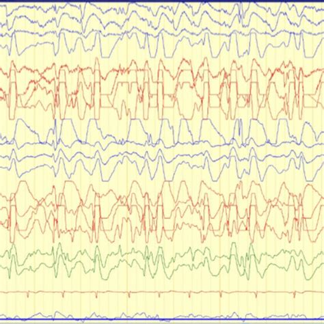 The Baseline EEG Bipolar Montage Sensitivity 7 MV Mm HF 70 Hz Download Scientific