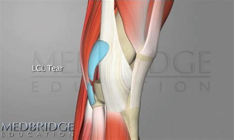 Lcl Tear Your Complete Guide To A Torn Lateral Collateral Ligament