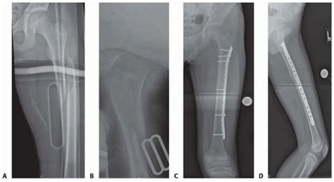 Submuscular Plating Of Pediatric Femur Fractures Musculoskeletal Key