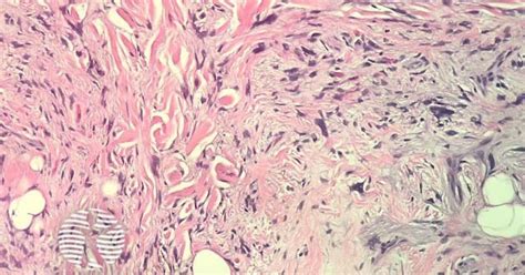 Neurofollicular Hamartoma Image