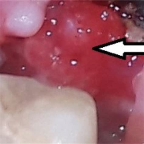 Arrow Showing Hypergranulation Tissue Within The Dry Socket And