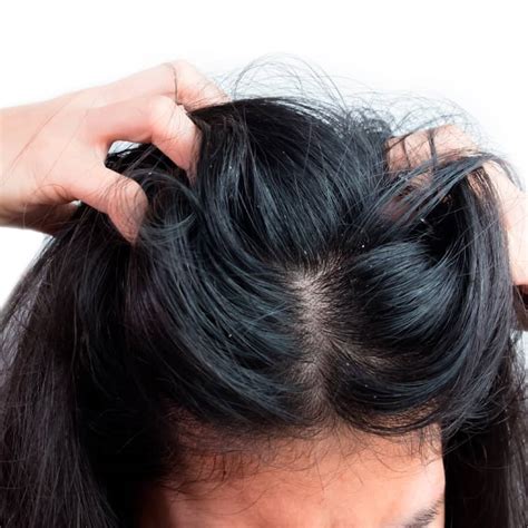 How To Get Rid Of Dandruff Dr Praneeth Skin Hair Laser Clinic