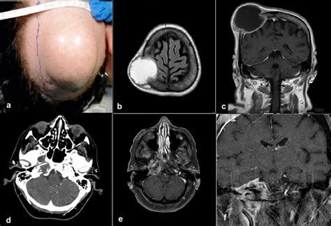 Skull Metastasis As A Primary Manifestation In Cervical Carcinoma