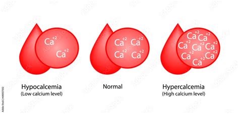 Hypercalcemia High Plasma Calcium Level And Hypocalcemia Low Plasma Calcium Level Calcium