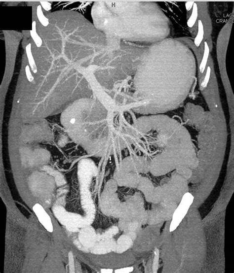 Radiation Enteritis Distal Small Bowel Small Bowel Radiology Case