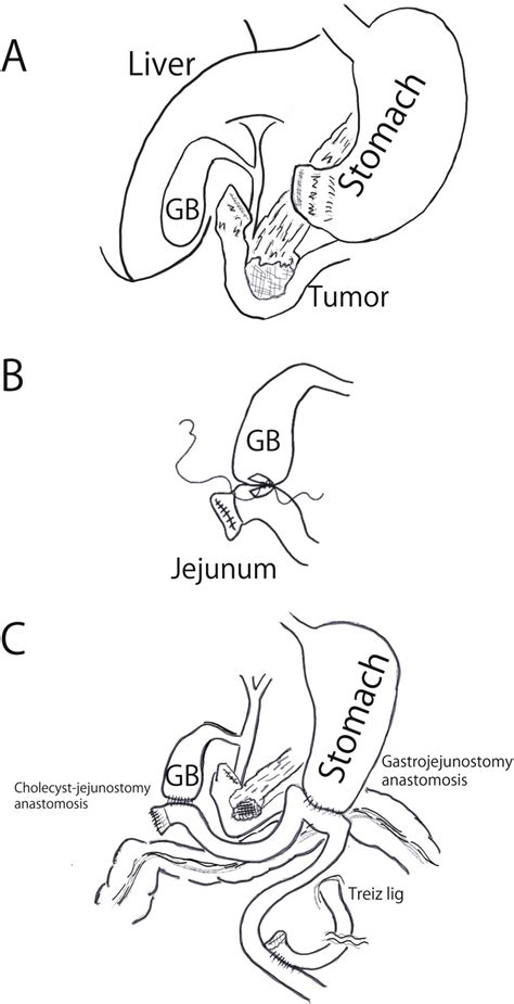 Cholecyst Jejunostomy For Palliative Surgery Pmc