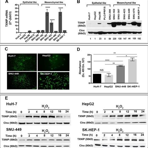 Txnip Levels In Normal Cirrhotic And Hcc Tumor Samples A B Txnip Download Scientific
