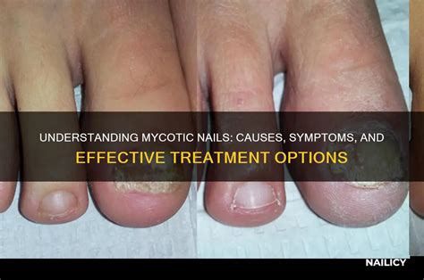 Understanding Mycotic Nails Causes Symptoms And Effective Treatment