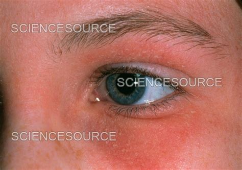 Eczema Around Eye Stock Image Science Source Images