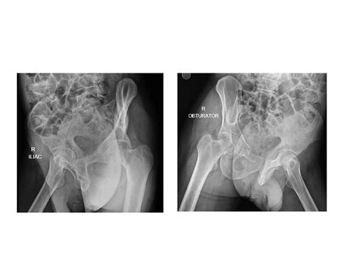 Imaging And Classification Of Acetabular Fractures Pptx