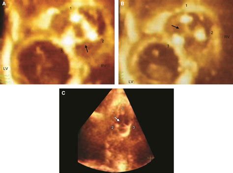Livereal Time Three Dimensional Transthoracic Echocardiography Of Tv Download Scientific