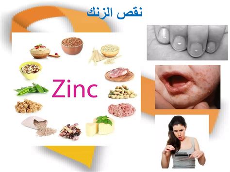 أمراض سوء التغذية عند الأطفال Pdf